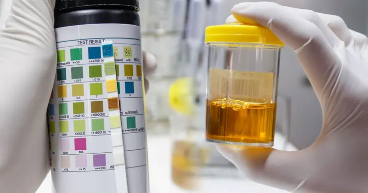 Urinekleur en betekenis: ontdek wat het zegt over de gezondheid